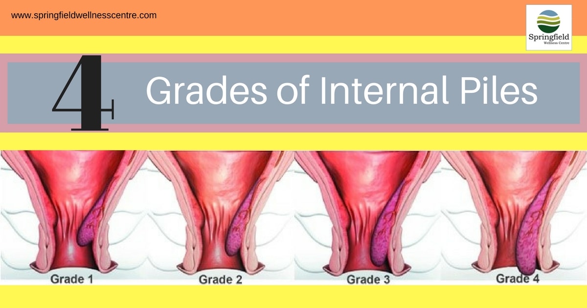 More About Grades Of Internal Piles Dr Maran Springfield Wellness More About Grades Of Internal Piles Dr Maran Springfield Wellness