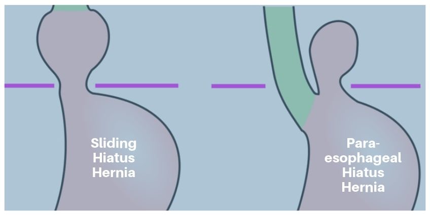 Hiatus Hernia